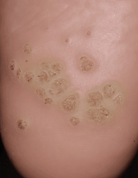 Causes Of Hand Warts